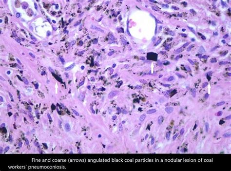 000 Coal Workers Pneumoconiosis Cwp The Common Vein