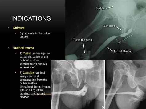 Ascending Urethrogram Pptx