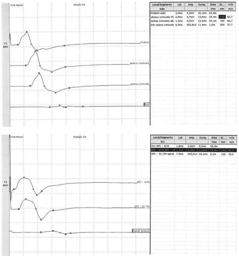 Right Ulnar Nerve Motor Conduction Block At Axila And Right Radial Download Scientific Diagram