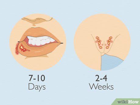 How To Recognize Herpes Signs Of Oral Or Genital Outbreaks