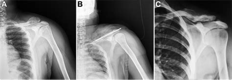 Aneurysmal Bone Cysts Of The Clavicle A Comparison Of Extended