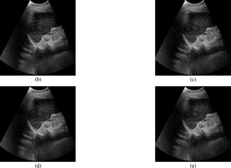 Figure 2 From Design And Implementation Of Speckle Noise Reduction