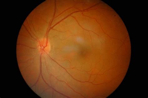 Diabetic Eye Disease