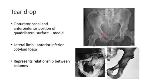Acetabulum Fractures Anatomy Radiological Evaluation Classification And Management Pptx