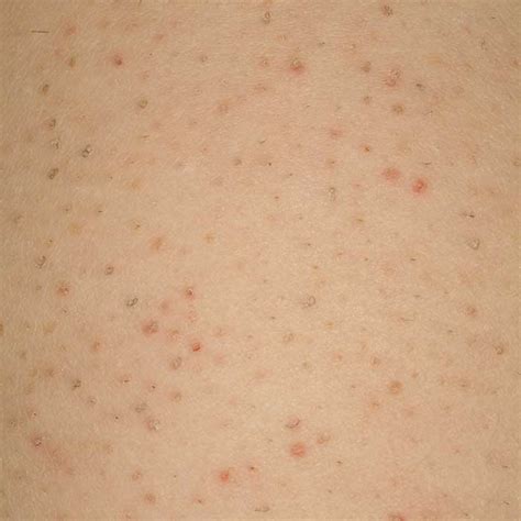 Ingrown Hairs On The Leg Most Skincare