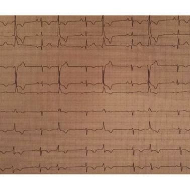 Electrocardiogram Shows Normal Sinus Rhythm ST Elevation In AVr ST Download Scientific