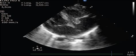 Case Report Staphylococcus Aureus Endocarditis In 2 Prematu Medicine