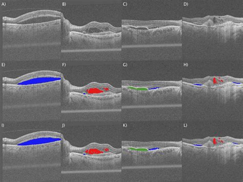 Deep Learning Based Multi Class Fluid Segmentation In Swept Source Oct
