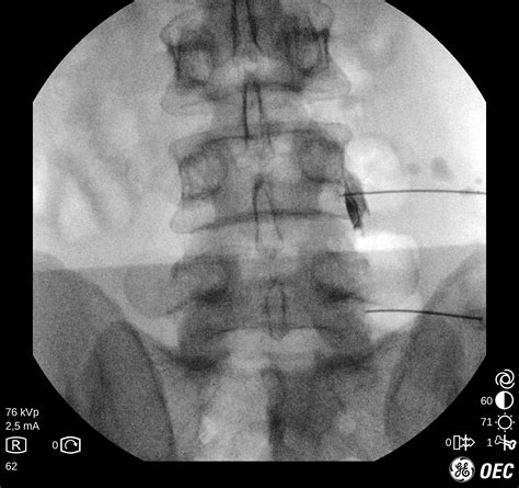 Spine Injections Arthrotech™