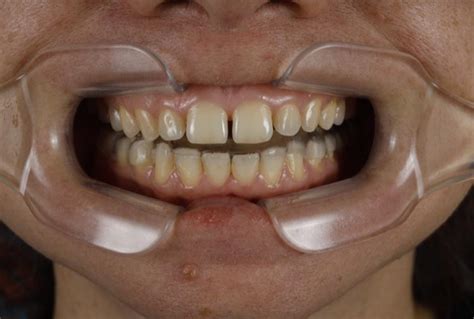 Decompression Therapy For Osteoarthritis Of The Right Tmj Restoring Symmetry Of Movement