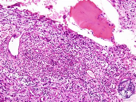 19 Bone Joint 5 Suppurative Osteomyelitis Pathology Core Pictures