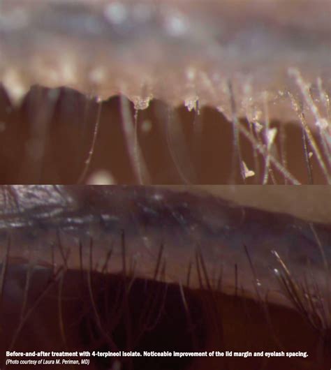 Treating Demodex Blepharitis Efficiently Before Surgery Ophthalmology Times