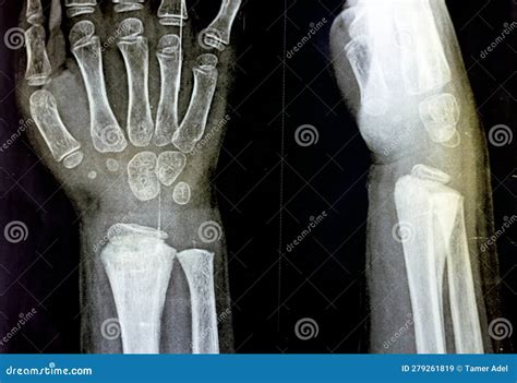 Plain X Ray Shows Avulsion Fracture Base Of The Distal Phalanx Of The Left Middle Finger