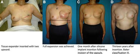 Immediate Case With Upward Displacement Of Tissue Expander A Tissue