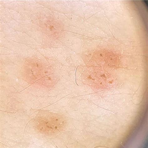 Patient B Rash On The Upper Limbs In The Form Of Flat Yellow Brown