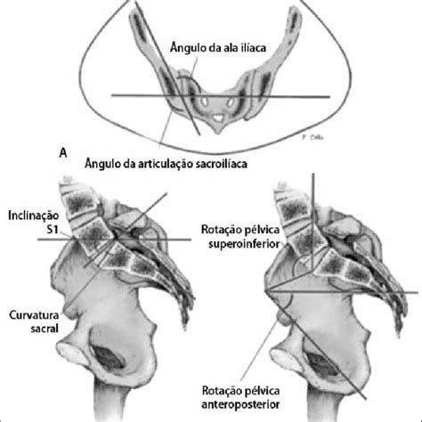 Pdf Bilateral Anterior Pelvic Osteotomy For Closure Of Bladder Exstrophy Description Of Technique