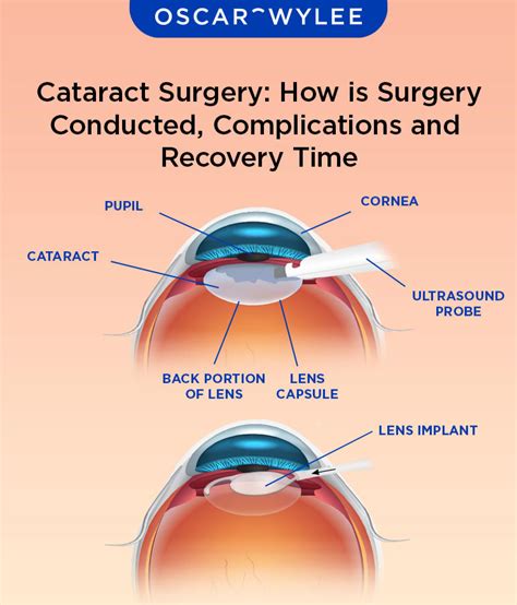 Cataract Surgery