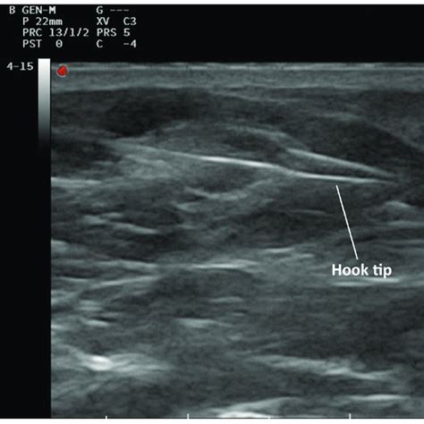 A The Figure Shows A Non Repositionable Localization Hook Wire