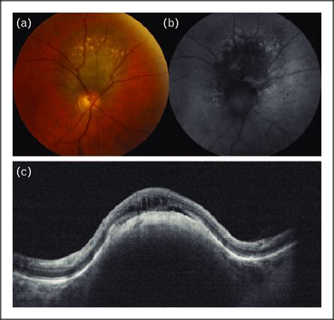 Juxtapapillary Choroidal Nevus A With Overlying Drusen Fundus Download Scientific Diagram