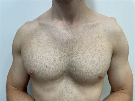 Acj Dislocation The Bone School