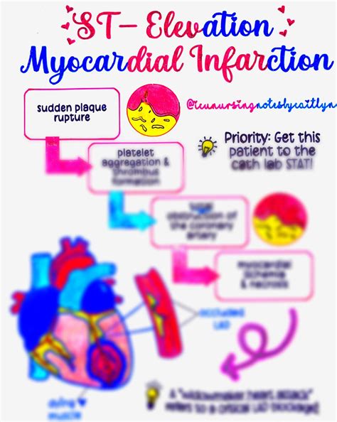 Pathophys Of A Stemi Etsy