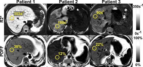 Liver Fat Mri At Philip Ayala Blog