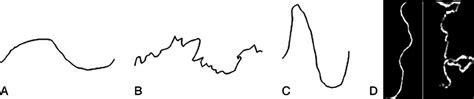Illustration Of Abnormal Tortuosity A Drawing Of A Healthy