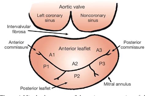 Figure 1 From Multimodality Imaging Assessment Of Mitral Valve Anatomy In Planning For Mitral