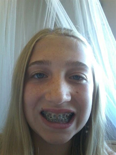 Pin On Braces