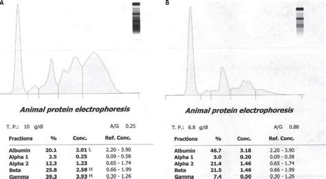 Polyclonal Gammopathy Semantic Scholar