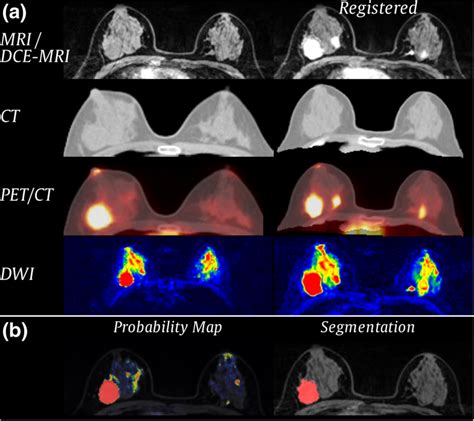 Automatic Segmentation And Classification Of Breast Lesions Through Identification Of