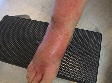 Bacterial Infections Cellulitis Bacterial Streptococcus Picture Hellenic Dermatological