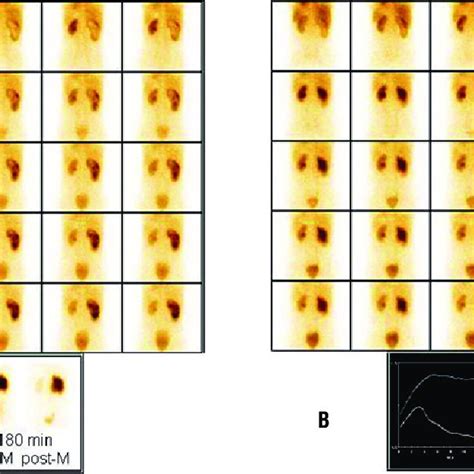 Dynamic Renal Scintigraphy With 99mtc Dtpa With Furosemide Download Scientific Diagram