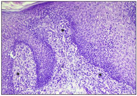 Plasma Cell Cheilitis As Angular Cheilitis Indian Journal Of