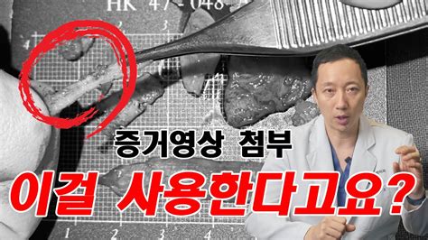 코수술시 기증늑연골을 사용 하면 안되는 확실한 증거영상 입니다 코성형 코성형보형물 기증늑연골 Youtube