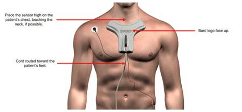 Colocación de catéteres PICC Comparativa de Pilot y Sherlock