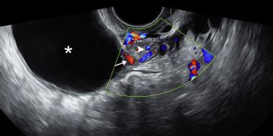 Ovarian Torsion Ultrasound Whirlpool Sign
