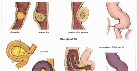Locclusion Intestinale Récap Ide