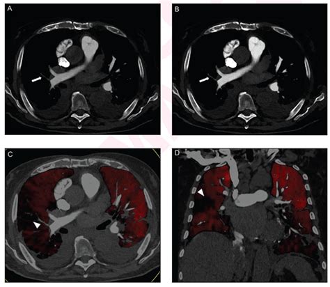 Is Photon Counting Ct A Better Option Than Dual Energy Ct For Pulmonary Angiography