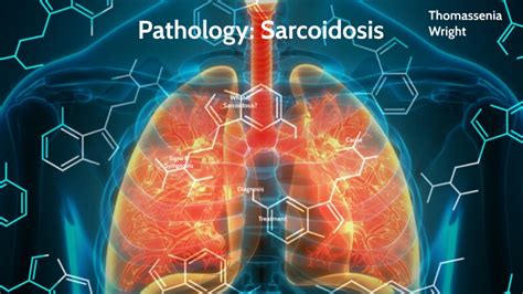 Pathology Sarcoidosis By Thomassenia Wright On Prezi
