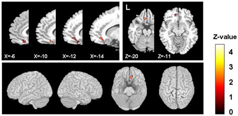 Sagittal And Transverse Sections Of The Statistical Parametric Map Of Download Scientific