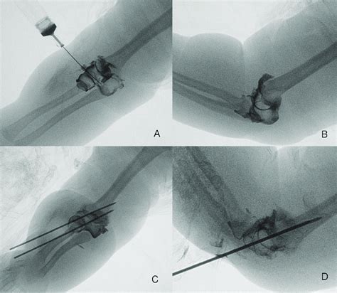 Pre And Postoperative Elbow Joint Arthrogram Of An 18 Month Old Girl