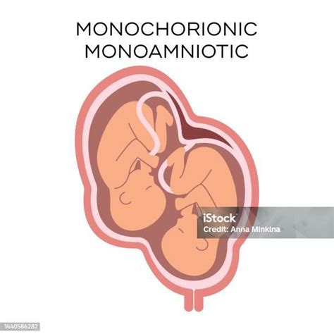 Monochorionic Monoamniotic Twins Stock Illustration Download Image Now Anatomy Human Embryo