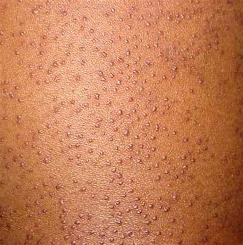 Keratosis Pilaris Pictures Treatment Symptoms And Causes Hubpages
