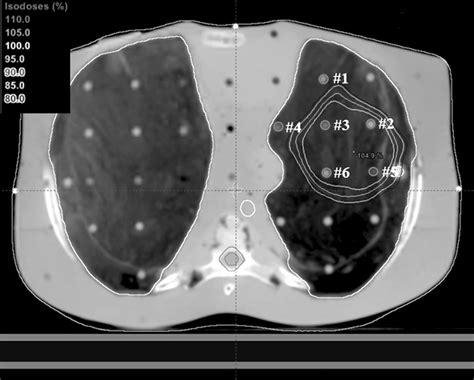 Dose Distributions Calculated Using The Pbc Aaa Algorithms In The Download Scientific Diagram