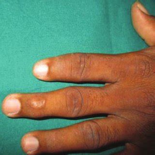 Short Left Index Finger Download Scientific Diagram