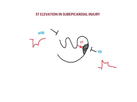 ECG Changes In Myocardial Ischemia Myocardial Infarction Pptx