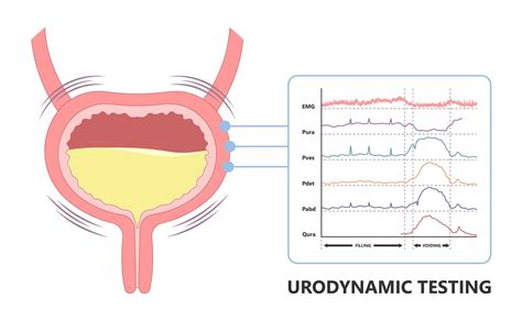 Urodynamics Testing For Bladder Function North Texas Upnt