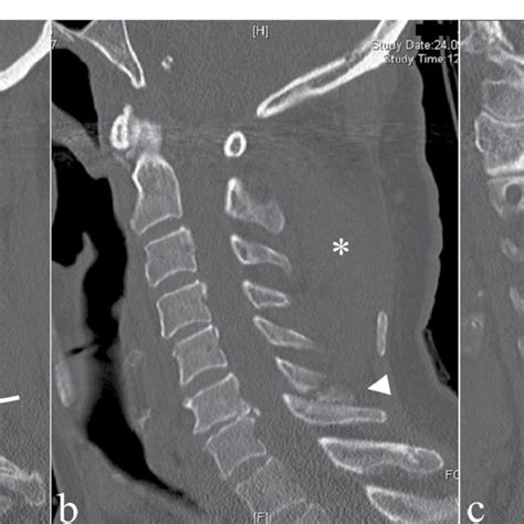 Pdf Is That Only A Spinous Process Fracture Report Of A Case Of A C6 Spinous Process Fracture