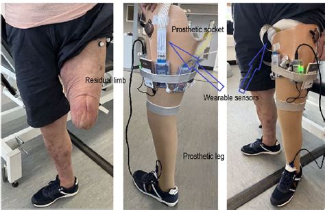 Figure 1 From Wearable Pressure Sensing For Lower Limb Amputees Semantic Scholar